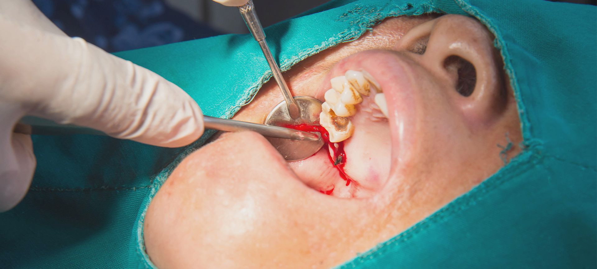Wisdom Teeth Removal — What to Expect - Discover Hidden